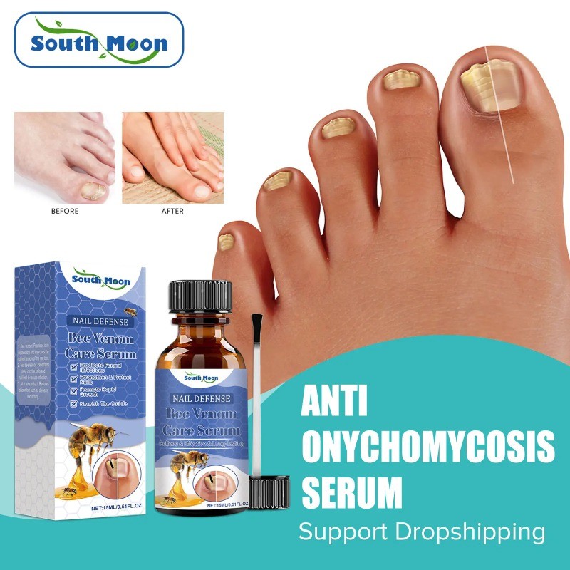 Nail Ingrown Cure Paronychia Removal Repair Onychomycosis Toenail ...