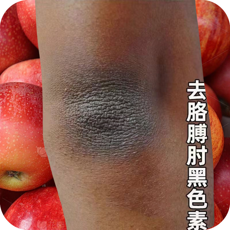 New Hand Elbow Joint Blackening Melatonin Elbow Blackening Peeling Dead ...