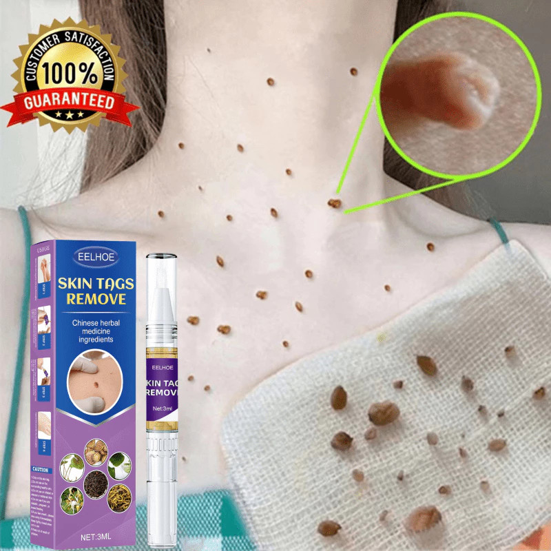 Wart Removal Warts Remover Original Cream Wart Removal Liquid Pen 3ml ...