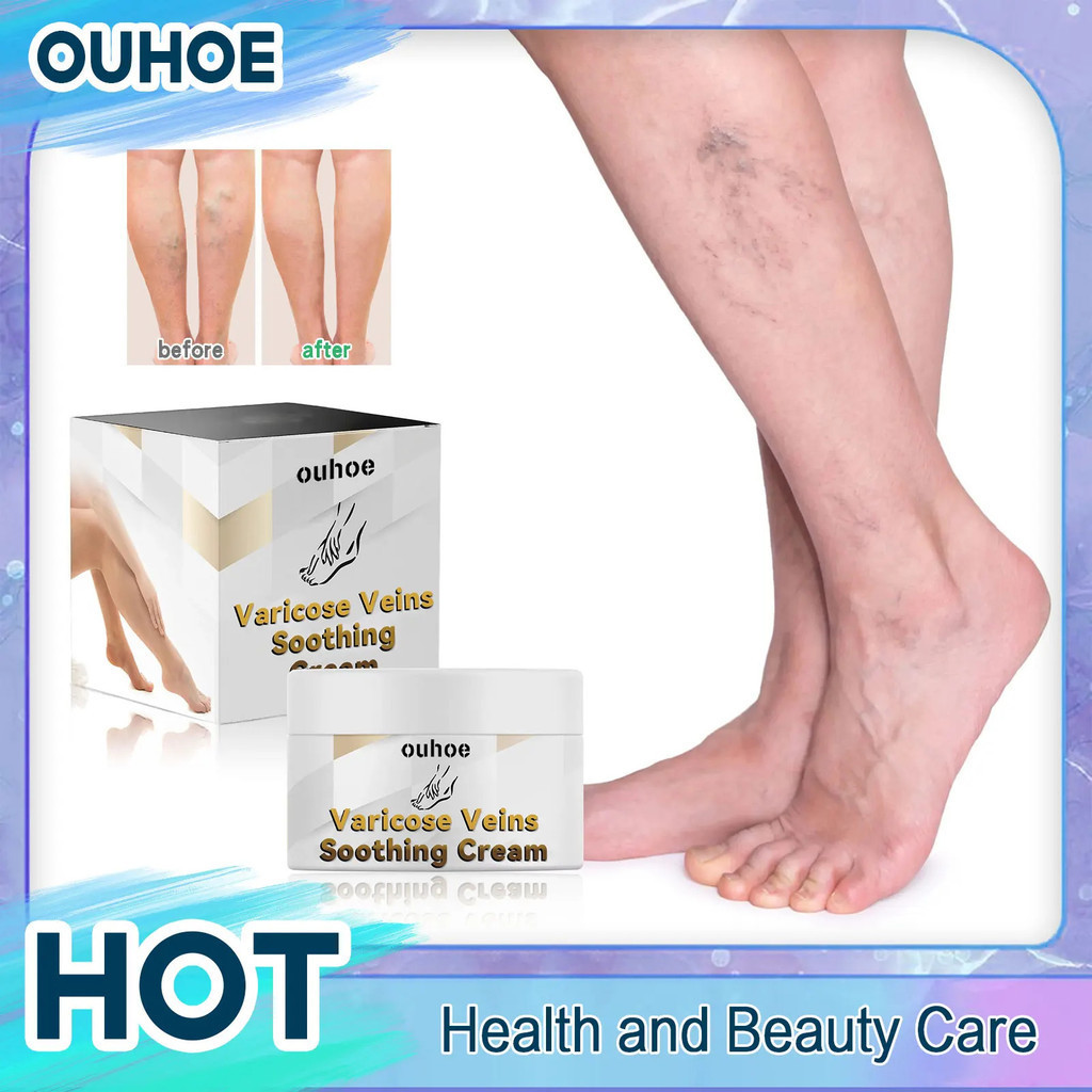 Relief Phlebitis Cream Eliminating Vasculitis Soothing Earthworm Spider ...