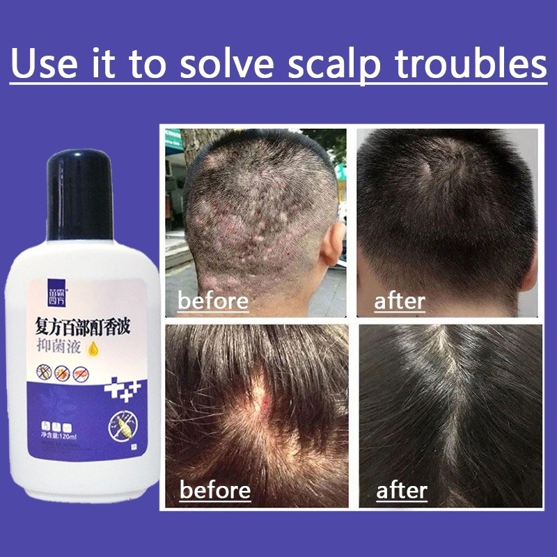 Drug lice human hair shampoo lice hair boy lice shampoo lice shampoo ...