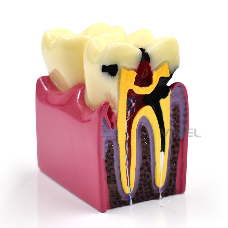 Dental Teeth Model 6x Size Molar Endo Root Canal Treatment Teaching ...