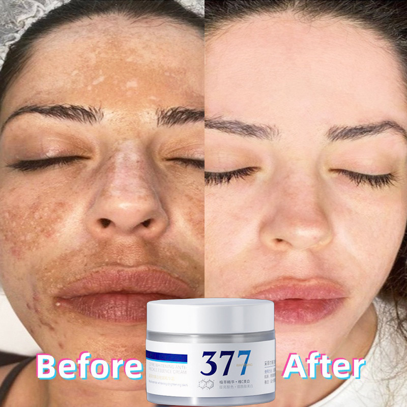New 377 Whitening cream Dark spot remover Anti melasma cream 50g Bright ...