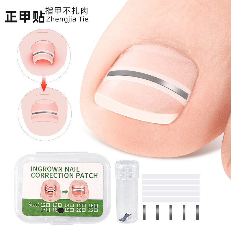 Recommended#Ingrown Toenail Correction Patch Ingrown Toenail Roll ...