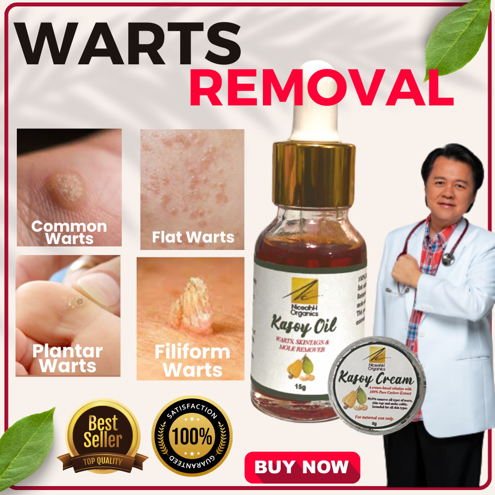 Original Kasoy Oil and Cream-Powerful Warts & Kulugo Remover|Genital ...