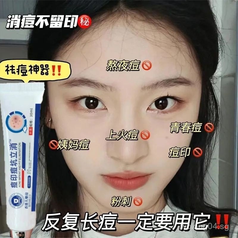 Fast Acne Removal Hong Kong Acne treatment cream Anti-Acne Marks ...