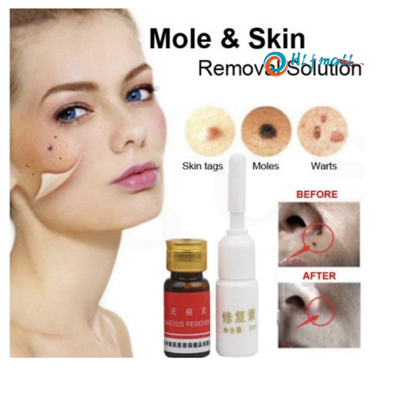 Mole & Skin Tag Removal Solution 100% Strong DIY Remover Skin Tags ...