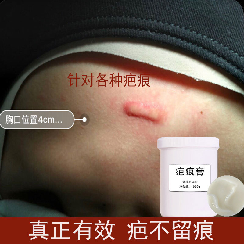 Scar Cream Repair Scar Caesarean Section Hypertrophic Scar Surgery Scar ...