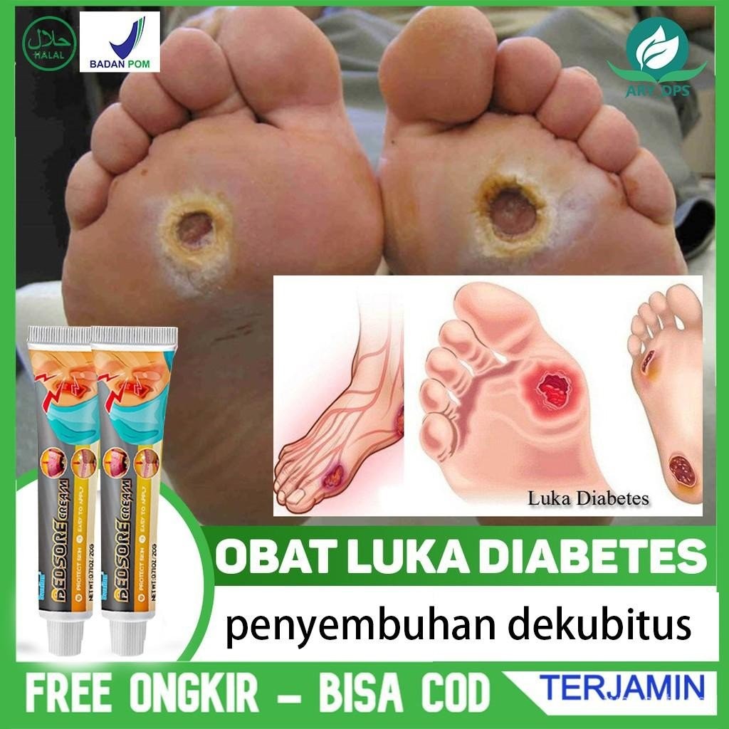 Antibacterial pressure ulcer ointment for wound healing decayed skin ...