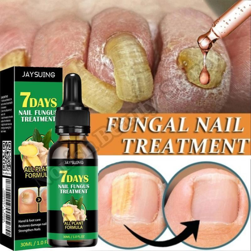 7-Day Nail Fungal Treatment Serum Foot Fungus Remedy Removal Products Anti Infection ...