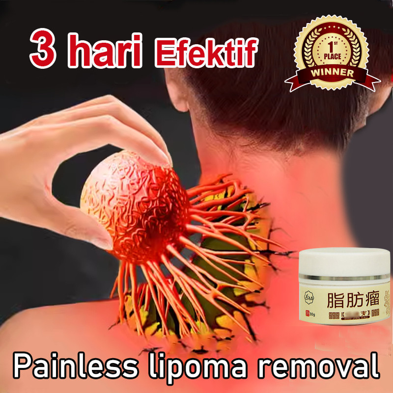 Lipoma Removal Cream 30g Removing Lumps in the Body Lymph Nodes ...