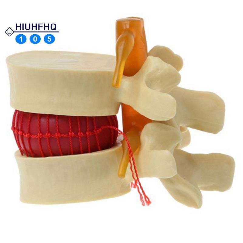 Lumbar Vertebrae Model Anatomical Spine Lumbar Disc Herniation Anatomy ...