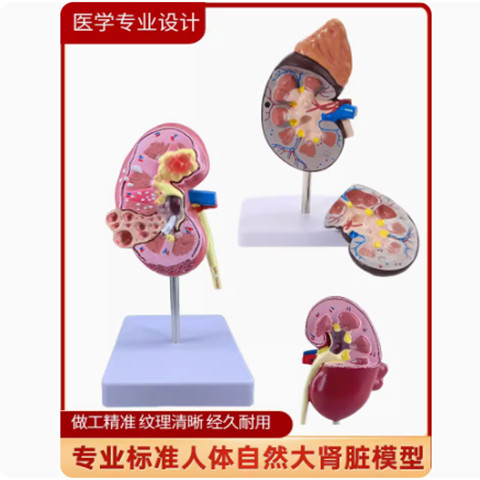 Human Kidney Anatomy Model Normal Kidney Model,Pathological Kidney ...