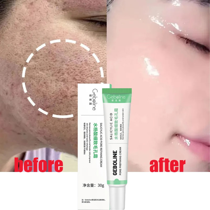 Salicylic Acid Pore Shrinking Cream Remove Blackehead Tighten Face ...