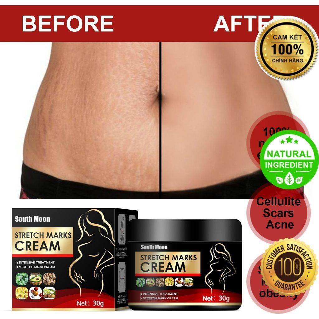 STRETCH CREAM - POST-BIRTH SCAR - ANTI-DRY SKIN, HELPING SKIN SOFT FROM ...
