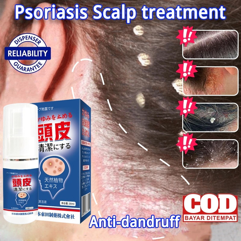 Seborrheic Dermatitis Spray 30ml Scalp Psoriasis Scalp Treatment Scalp ...