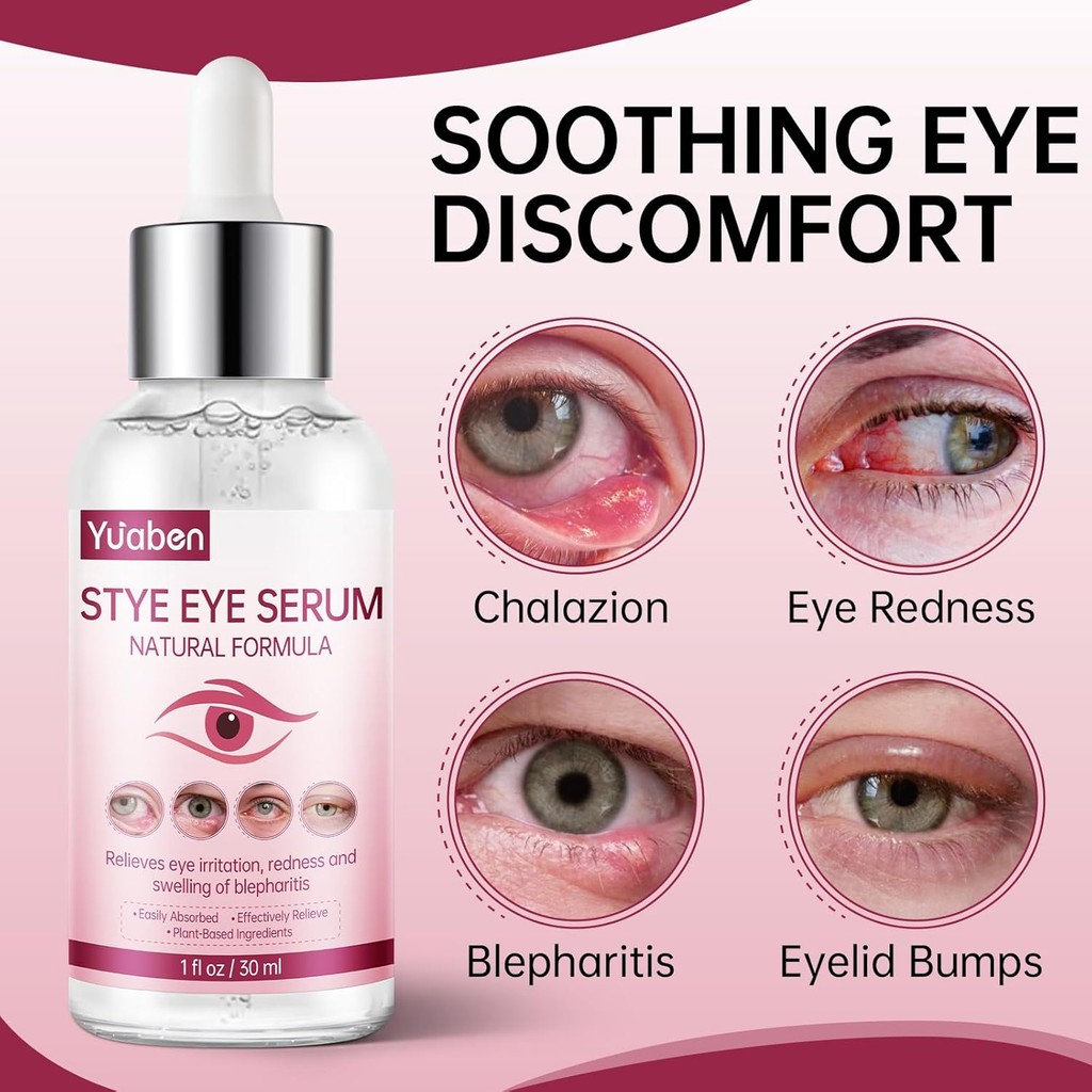 Stye Eye Treatment, Eye Stye Remover, Stye Eye Relief Drops for Stye ...