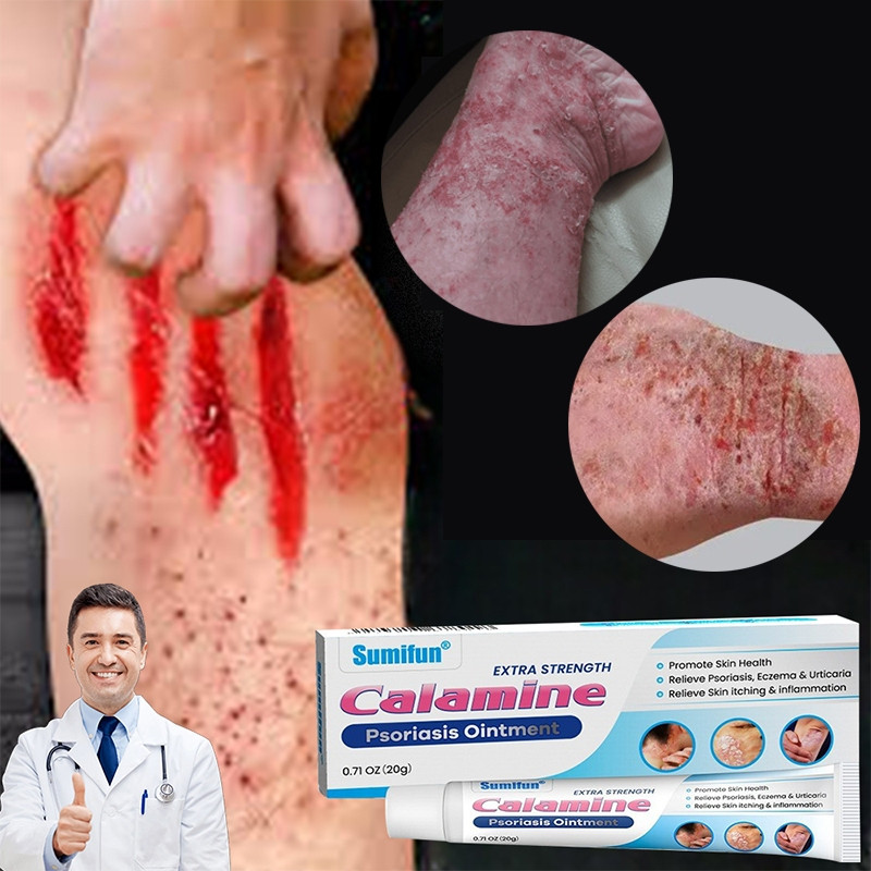 Psoriasis Cream Eczema Cream itchy skin cream Anti-fungal & itch ...