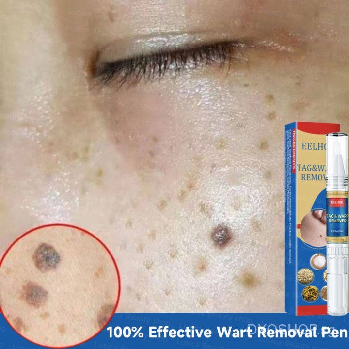 Flat Eliminate Wart Pen Wart Liquid Hand Foot Warts Remove Filiform ...