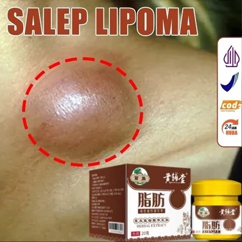 Lipoma Removal Cream Removing Lumps in the Body Lymph Nodes Multiple ...