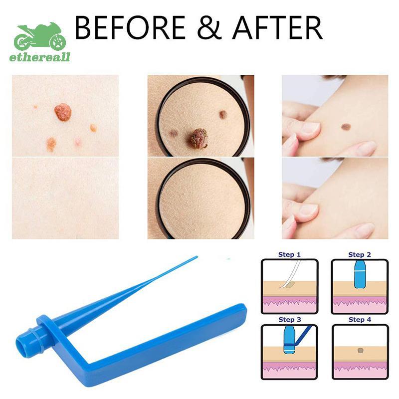 ETH Skin Care Rubber Bands Skin Tag Remover Skin Tag Removal Kit Face ...