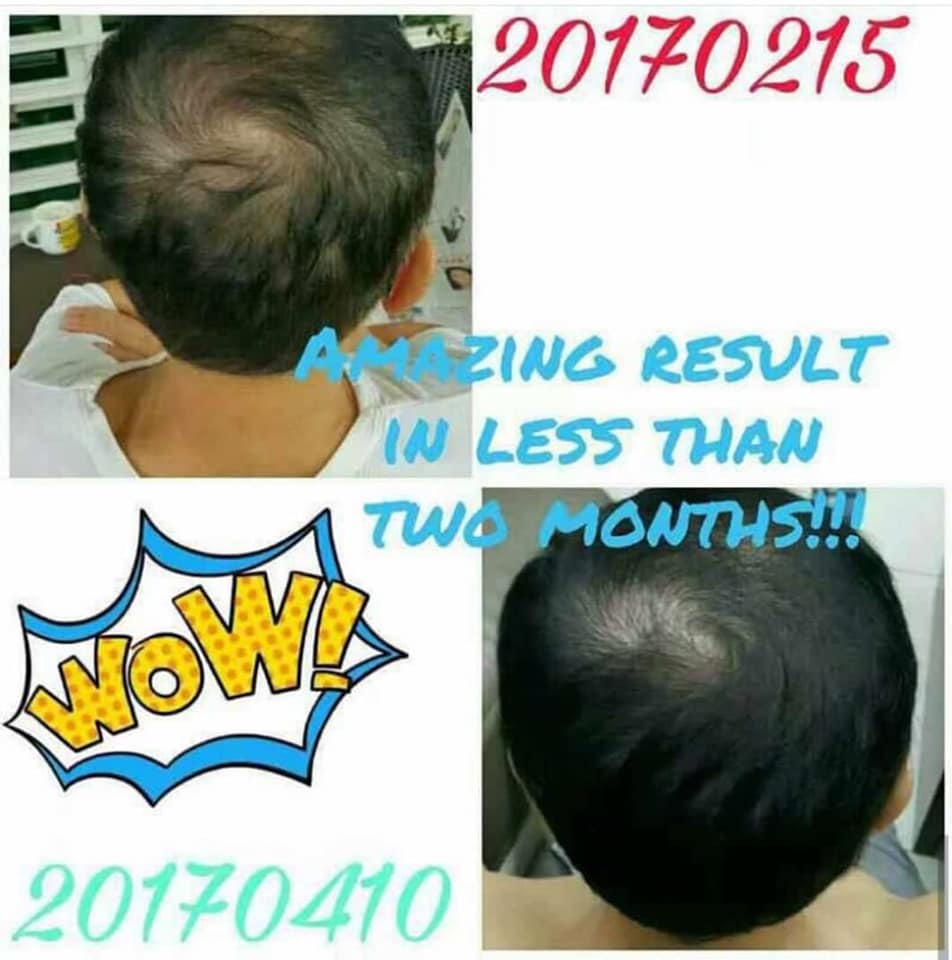 ATOMY Hair Growth/ Hair Loss Treatment Absolute Shampoo + Saengmodan ...