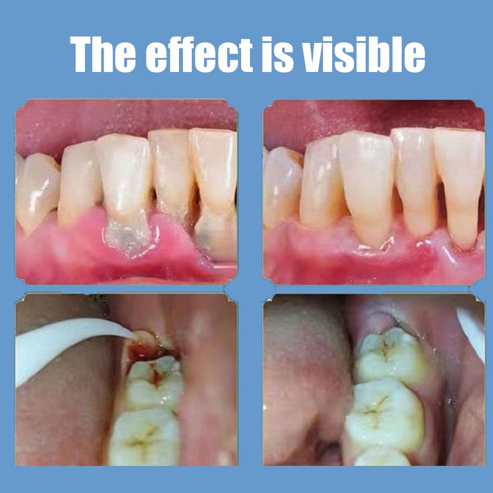 Quickly Repair Toothpaste Of Cavities Caries Whitening Toothpaste To ...