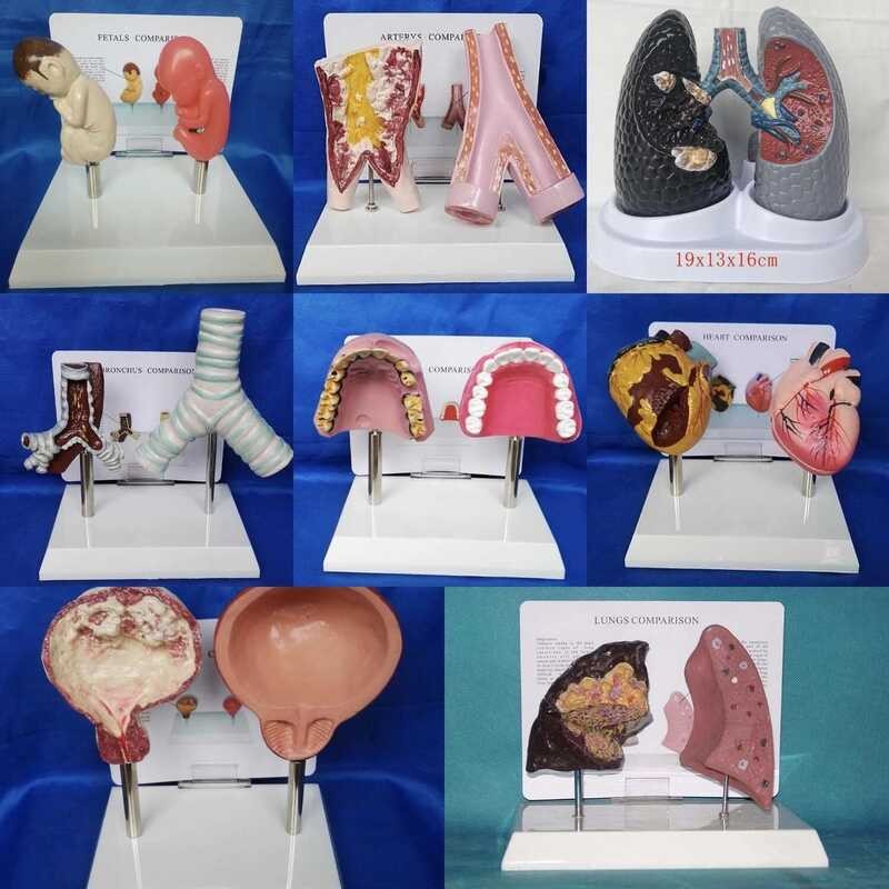 Comparison Of Normal Vs Smoking Pathological Organs Heart, Lungs ...