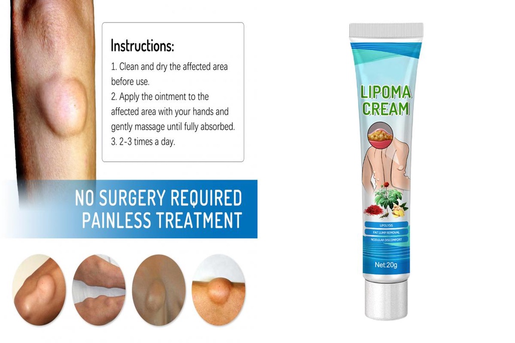 channelly Quick Effect Lipoma Removal Cream for Body Body Fatty Lump ...