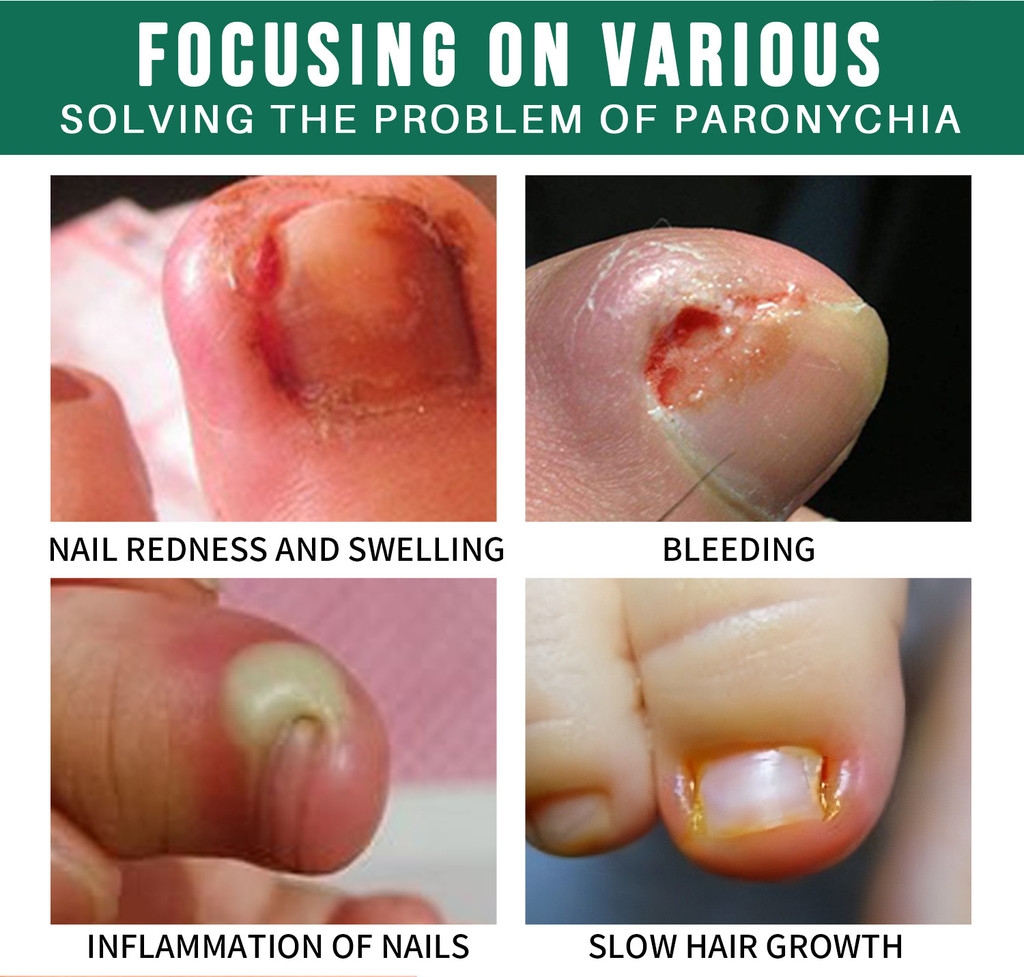 【in stock】Anti Paronychia Relief Oil Ingrown Toenail Anti Fungal Toe ...