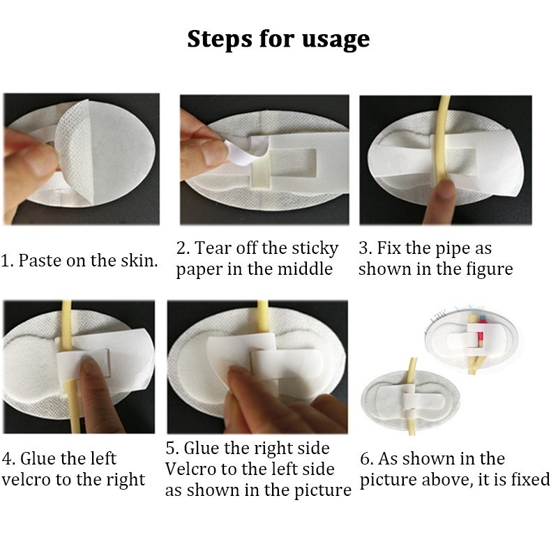 【Catheter Stickers】Body surface catheter fixing patch//Urinary catheter ...