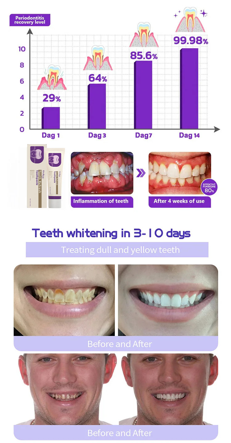 🚀Best Price🚀[Dentist Recommended] Advanced Whitening Toothpaste For ...