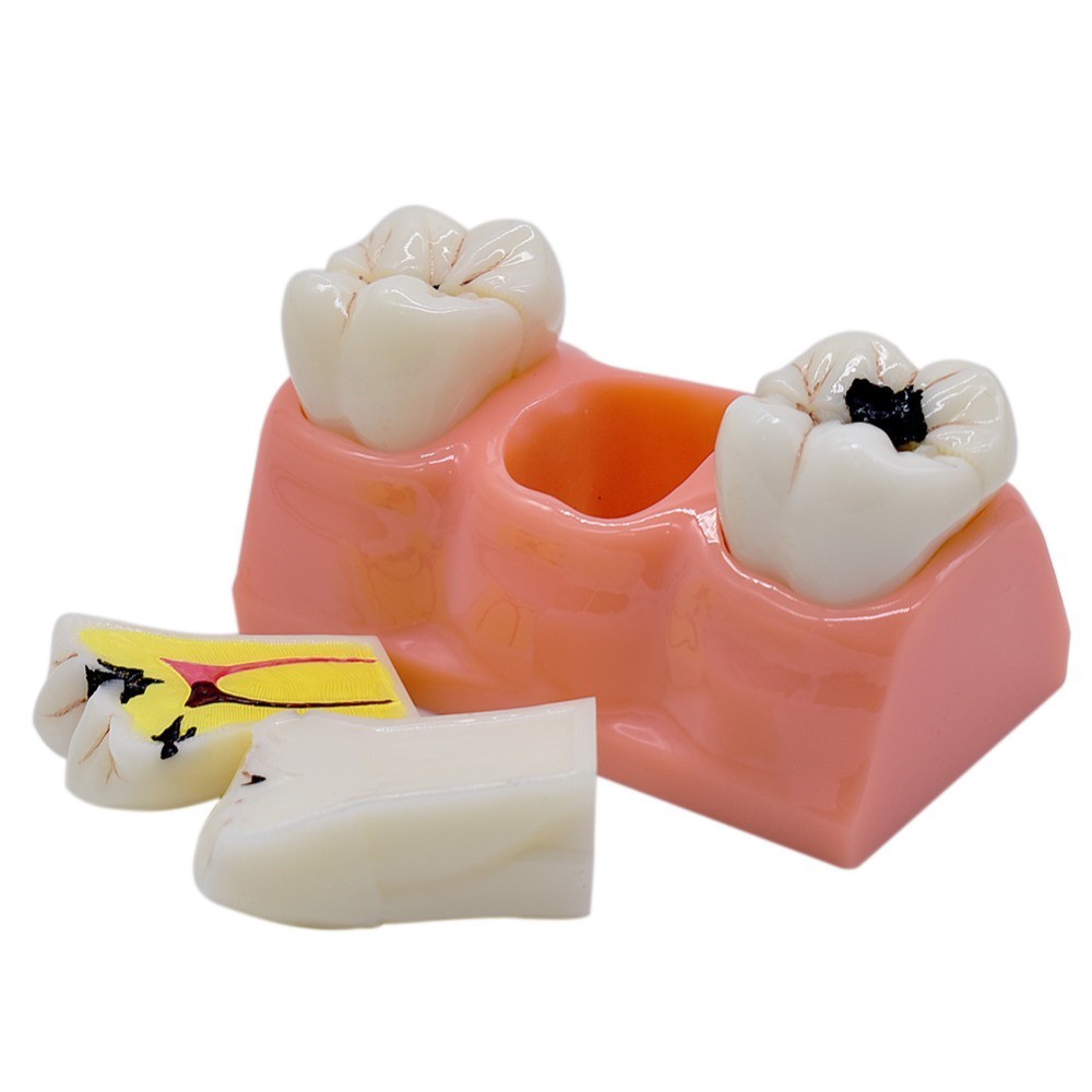 Dental Model Four Times Caries Evolution Model Tooth Decay ...