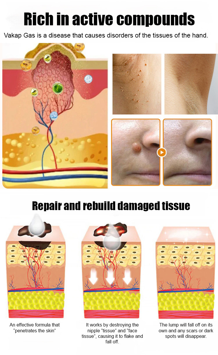 🔥Wart Removal🔥Quick Wart Removal Patch/Plant-Based Wart Removal/Plant ...