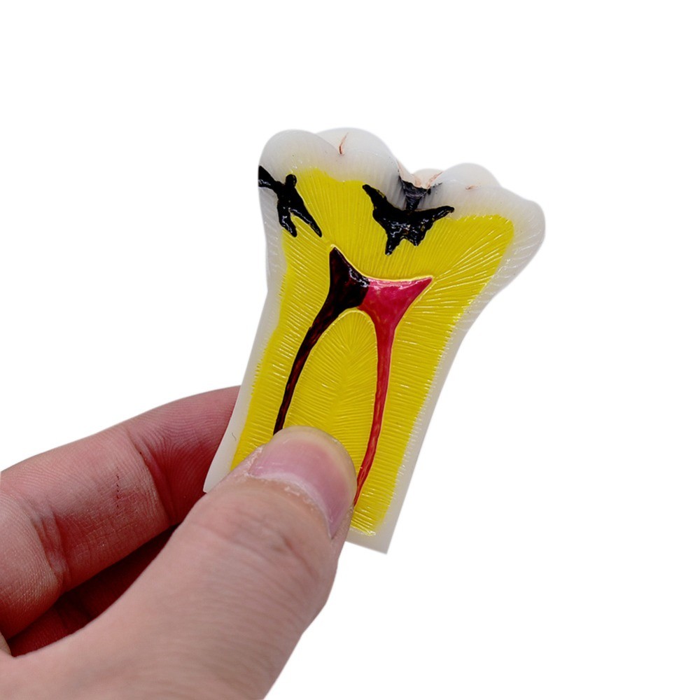 Dental Model Four Times Caries Evolution Model Tooth Decay ...
