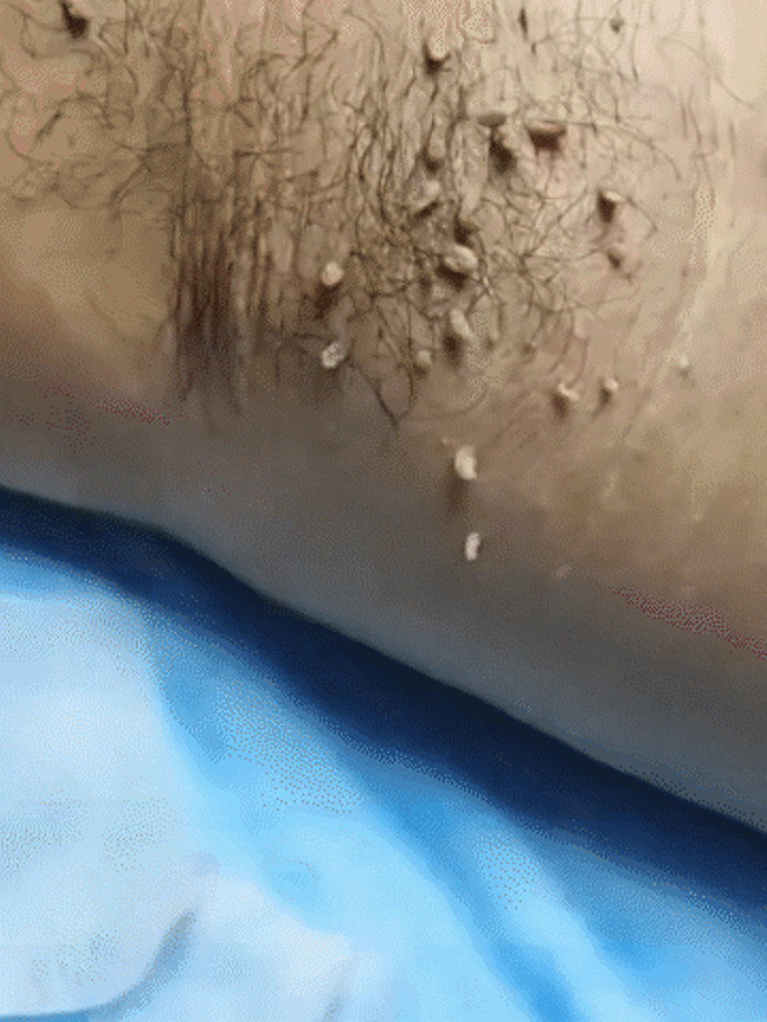 Filamentous wart cream antibacterial milk meat monkey wart cream ...