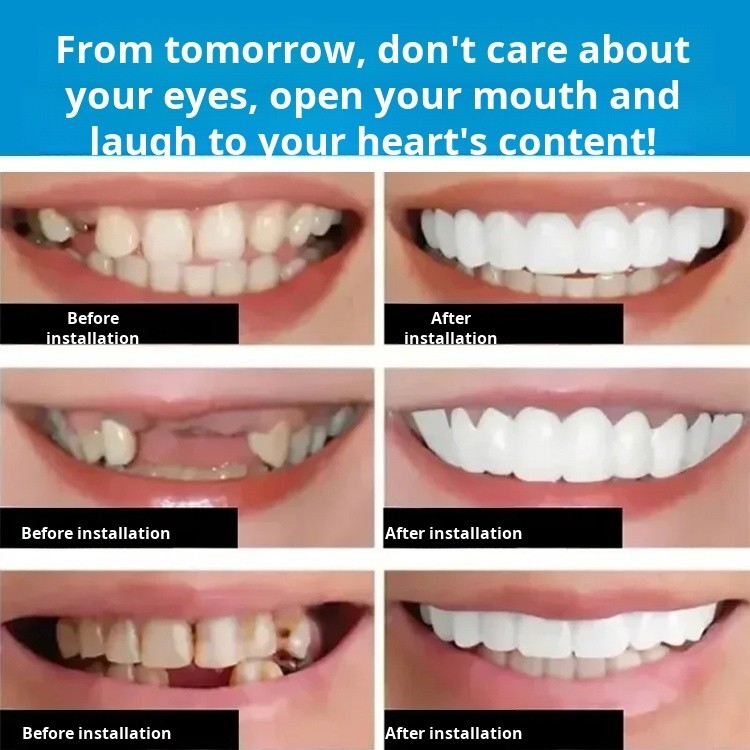 【SorriBem Perfect Smile Dentures 】自信微笑男女通用假牙 Snap-on dentures/ Uniform ...