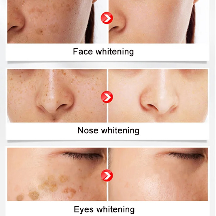 【Ready Stock】[Removing Spot/Brightening/Hydrating] Hyperpigmentation ...
