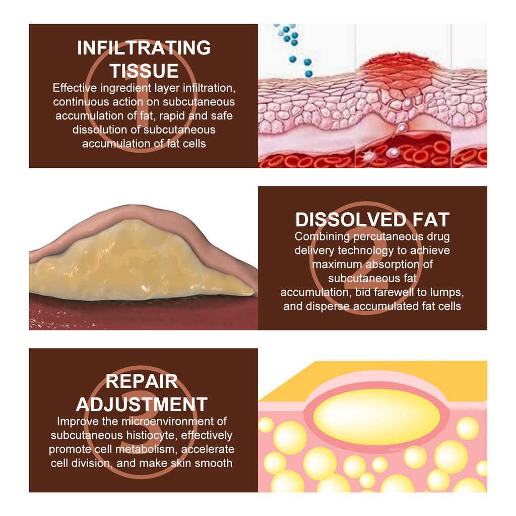 Soothing Cream Subcutaneous Lumps Remover,Fat Lump Skin Hard Mass ...