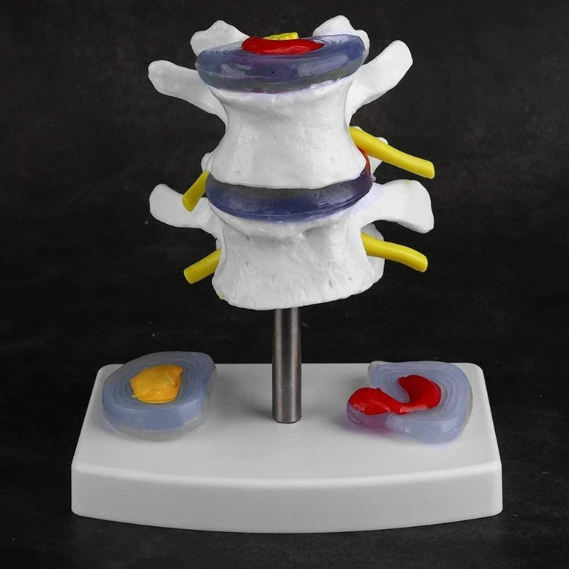 Intervertebral Disc Herniation Bone Pathology Model Lumbar Spine Bone ...
