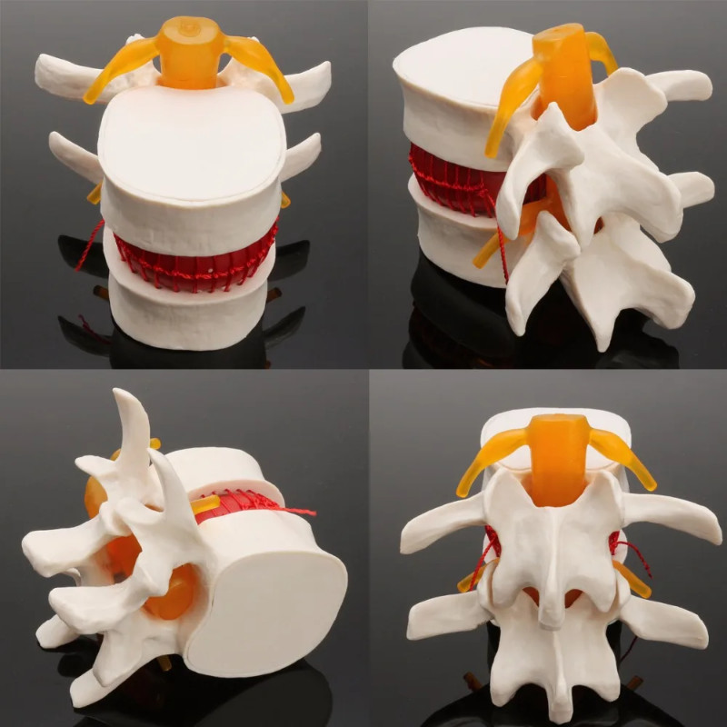 Human Anatomy Skeleton Spine Lumbar Disc Herniation Teaching Model ...