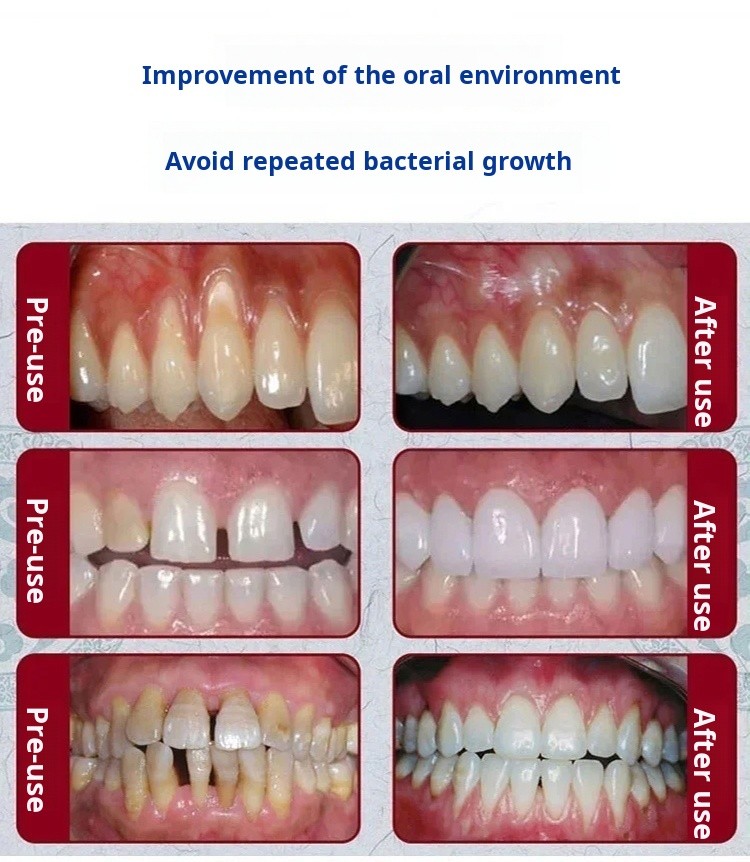 ⚡BUY1 FREE1⚡Fresh Breath/Remove Tartar[Dental Specialty]Loose Teeth ...