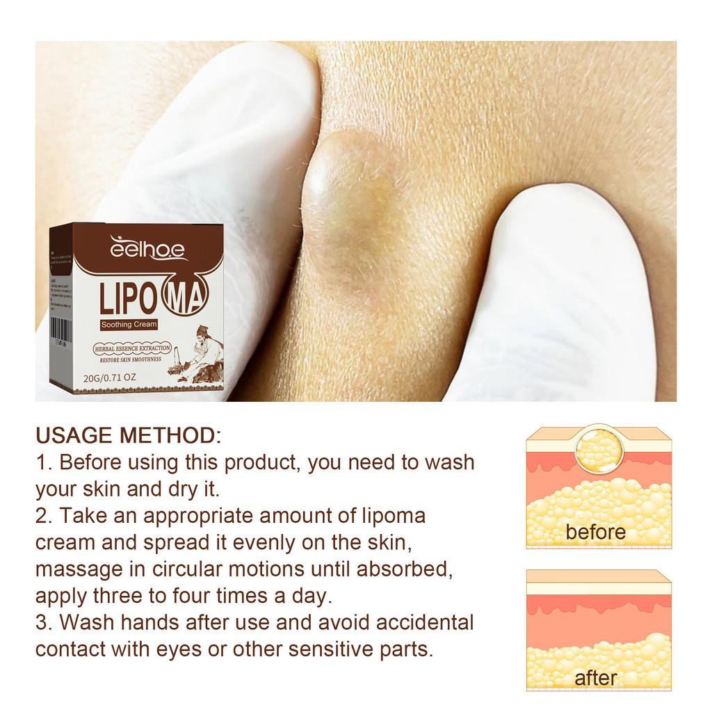 Soothing Cream Subcutaneous Lumps Remover,Fat Lump Skin Hard Mass ...