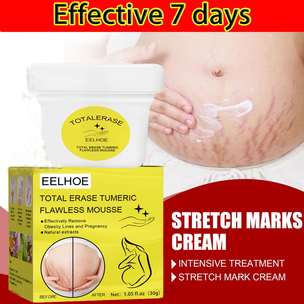 Scar Repair Cream Acne Scars Remove Pregnant Women Skin Care Stretch ...