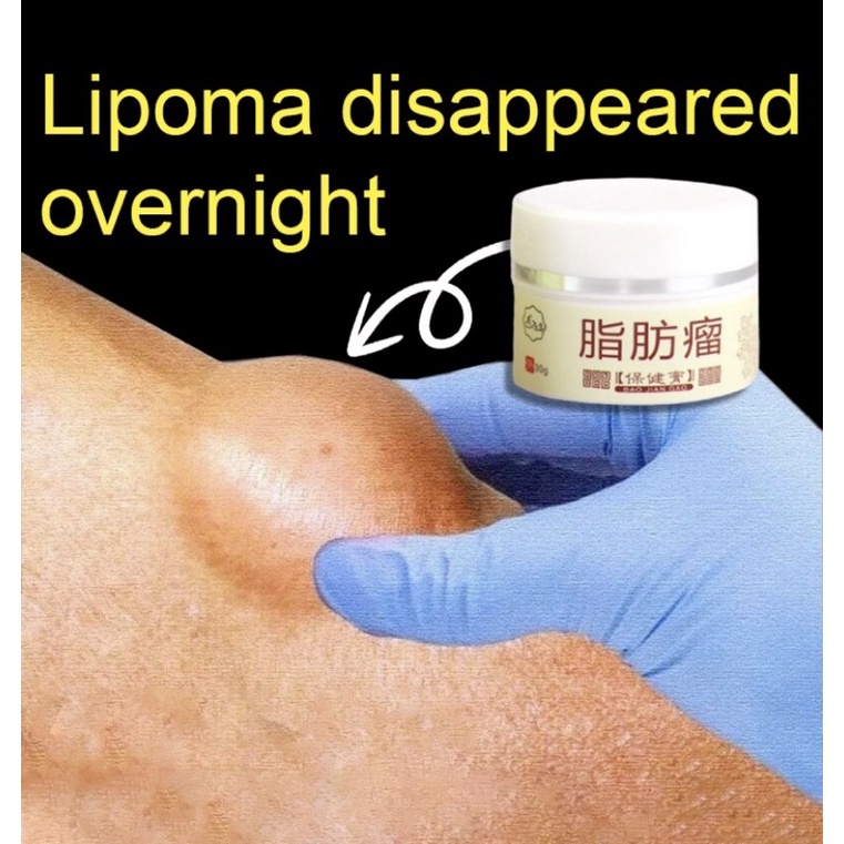 100 % Original Lipoma Removal Cream Special Gel Removing Multiple ...