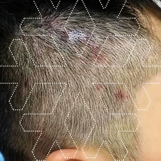 Head folliculitis, scalp pustules, pimples, itchy scalp, dandruff, acne ...