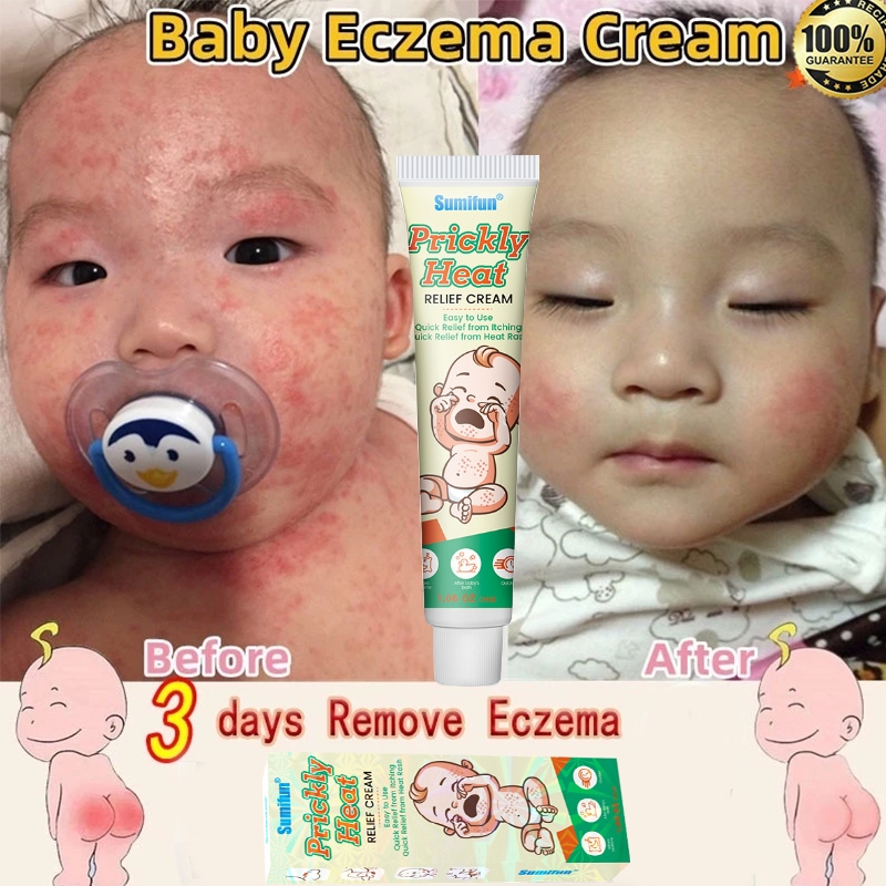 Infant eczema cream Anti itch cream 30g Herbal Baby prickly heat cream ...