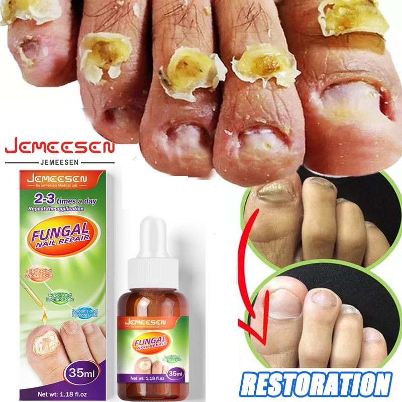 【NEW】Jemeesne Toe Nail Fungus Treatment Liquid 35ml Nail Repair Essence ...