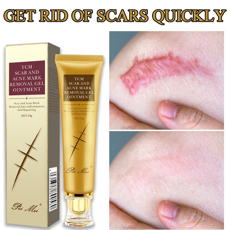💓Get rid of scars in 7 days💓Scar Repair Cream 30g Effective Scar ...