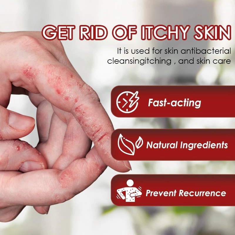 Antibacterial cream anti itching cream eczema ointment Effective treats ...